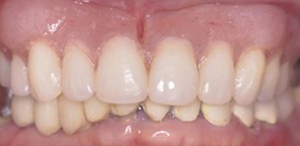 Before and After Dentures | Absolute Family Dentistry