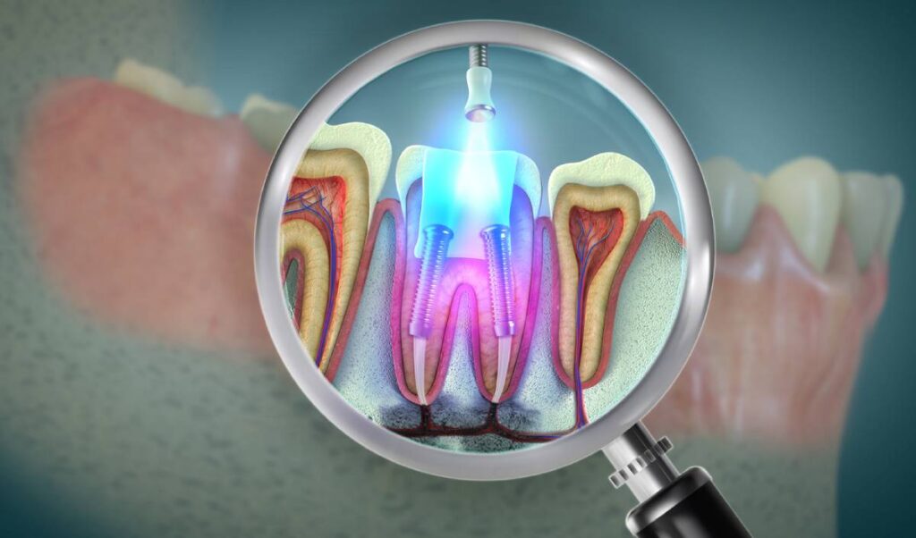How Long Does the Root Canal Procedure Take? | Absolute Family Dentistry
