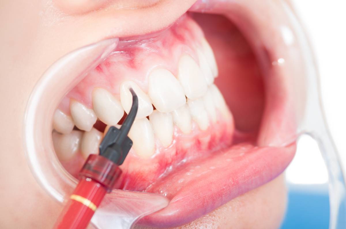 What Are Composite Fillings? | Absolute Family Dentistry